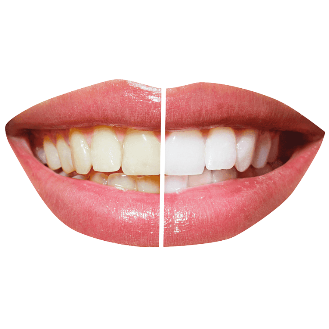 2 Tips for Getting the Best In-Office Teeth Whitening Results | Smile Pop